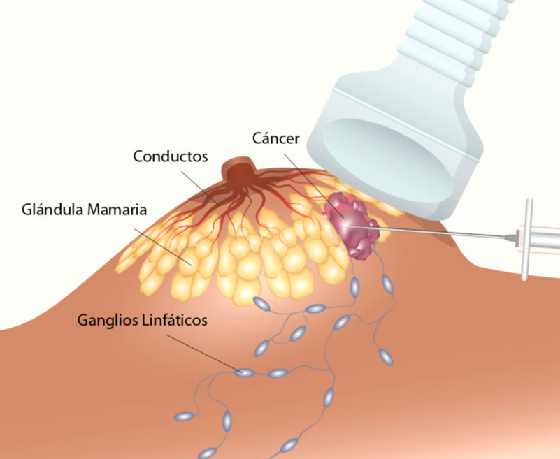 Cómo detectar precozmente el cáncer de mama - Fundación Arturo López Pérez