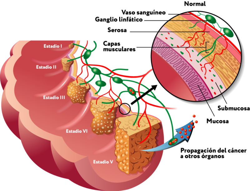 Cáncer colorrectal - Fundación Arturo López Pérez