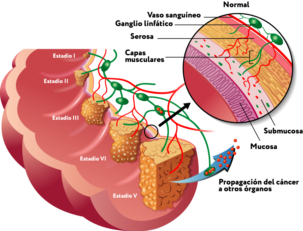 Cáncer colorrectal - Fundación Arturo López Pérez